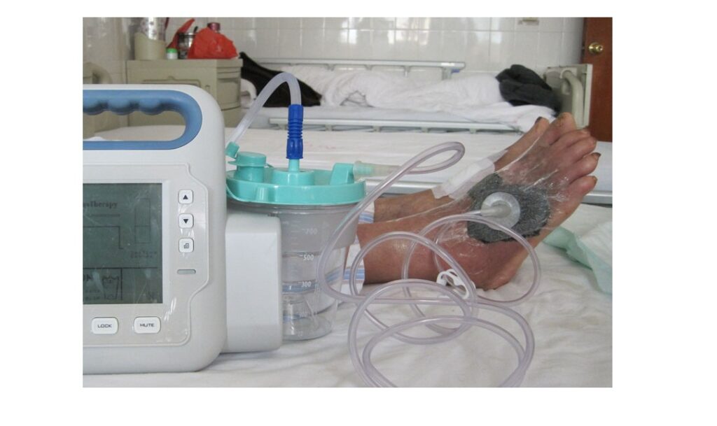 Foryou Npwt /negative Pressure Wound Treatment - MEDICAL AND DENTAL ...